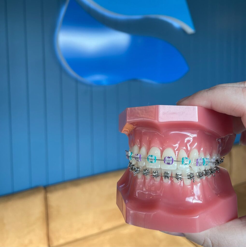 How Do Braces Straighten Your Teeth? - Peak Orthodontics